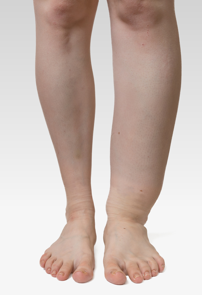 Home Remedies To Treat Edema In Legs And Feet 2023 