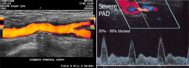 Peripheral Arterial Disease | Center for Vascular Medicine